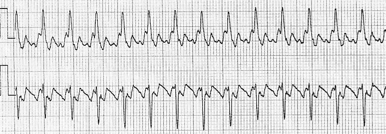 Ablation of AFL/AT: Main Page