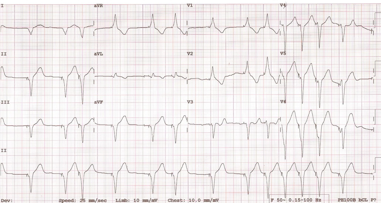 Cardiac Rhythm Device Troubleshooting