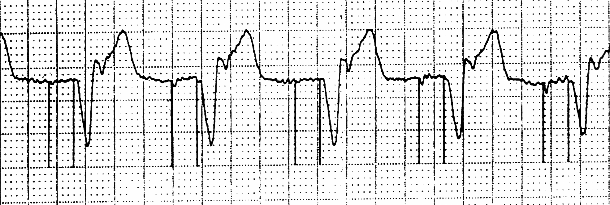 Cardiac Rhythm Device Troubleshooting