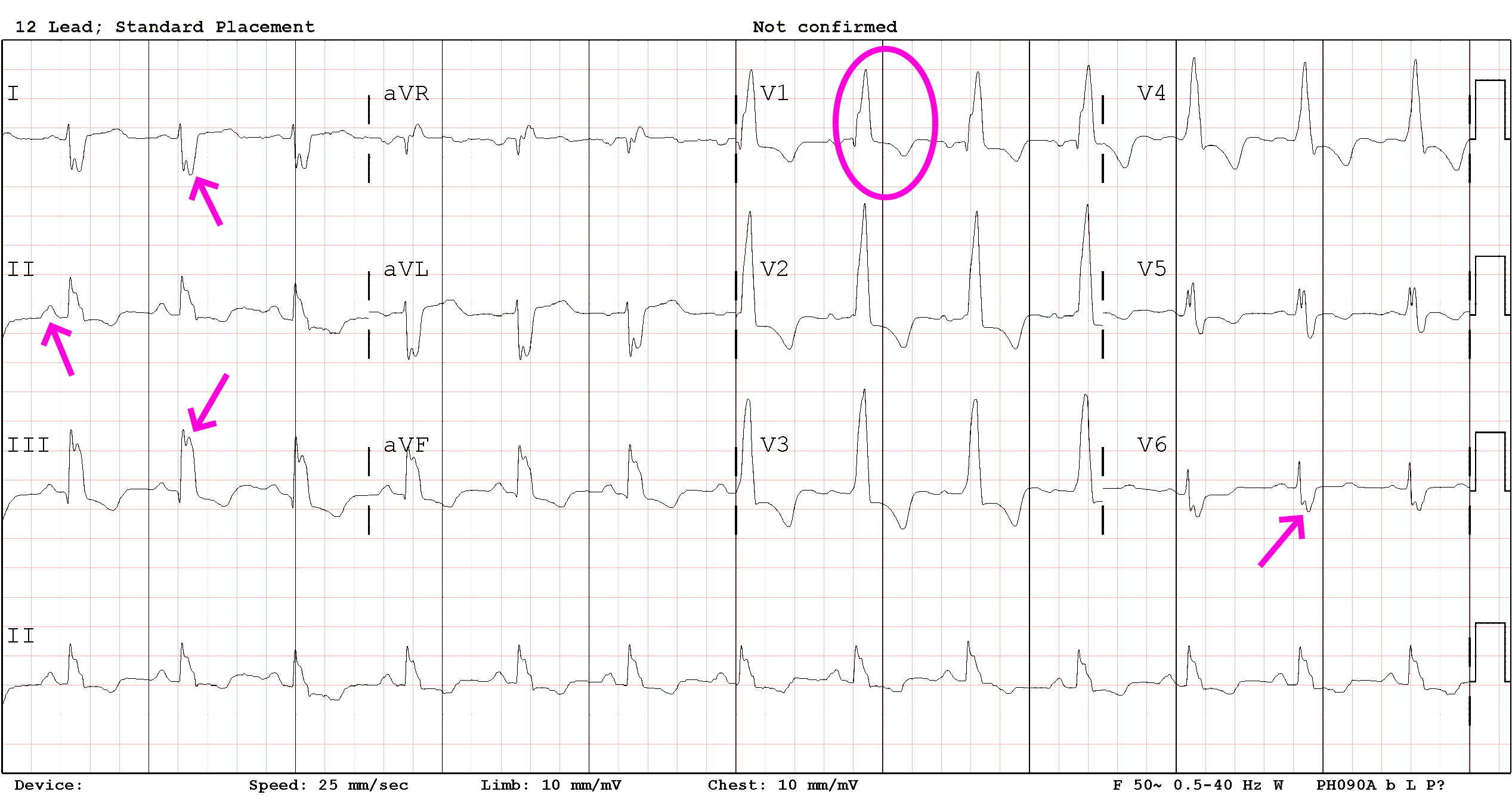 RV overload: RA and RV enlargement, RV strain, and RBBB.